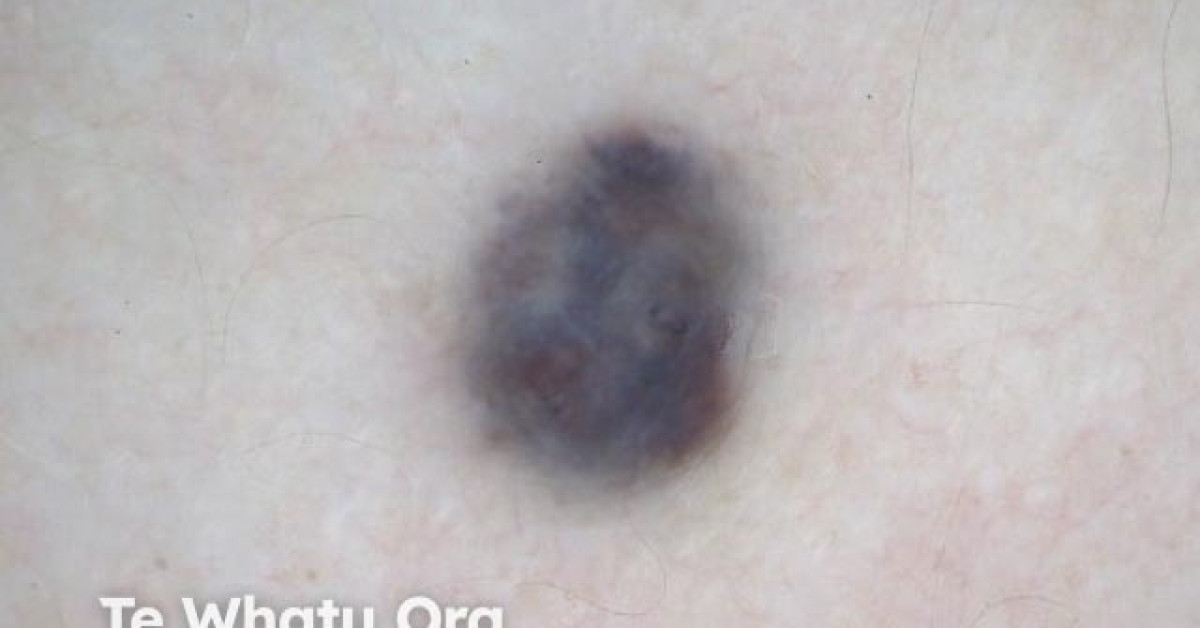 Blue naevus, skin type 1 dermoscopy image
