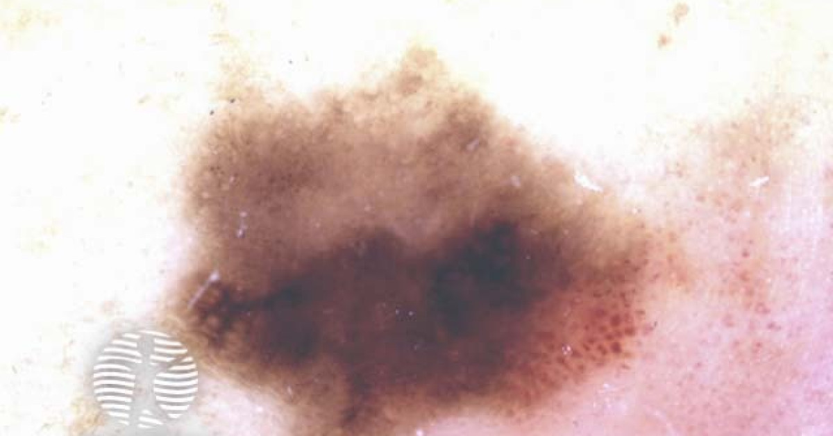 Pigmented intraepidermal carcinoma dermoscopy image