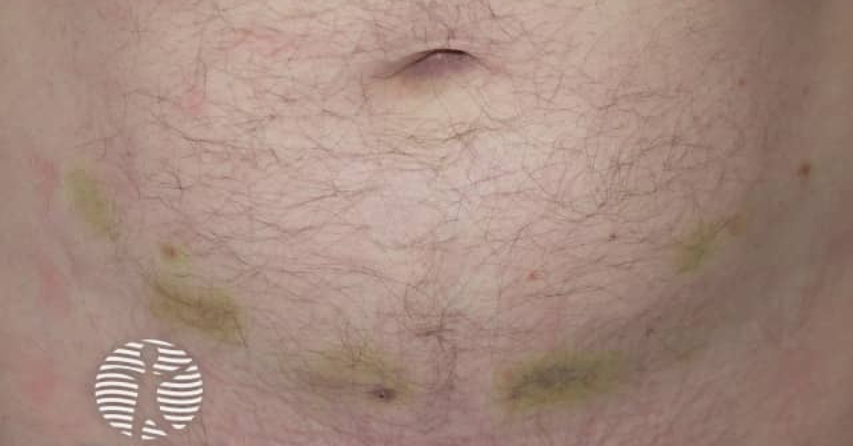 Bruising at site of heparin injections image
