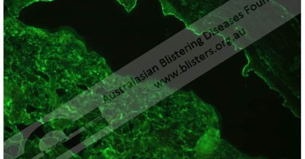 Bullous pemphigoid indirect immunofluorescence image