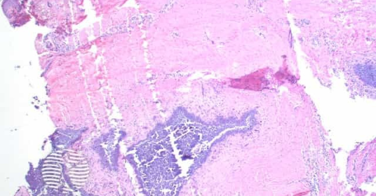 Calcinosis cutis histology image