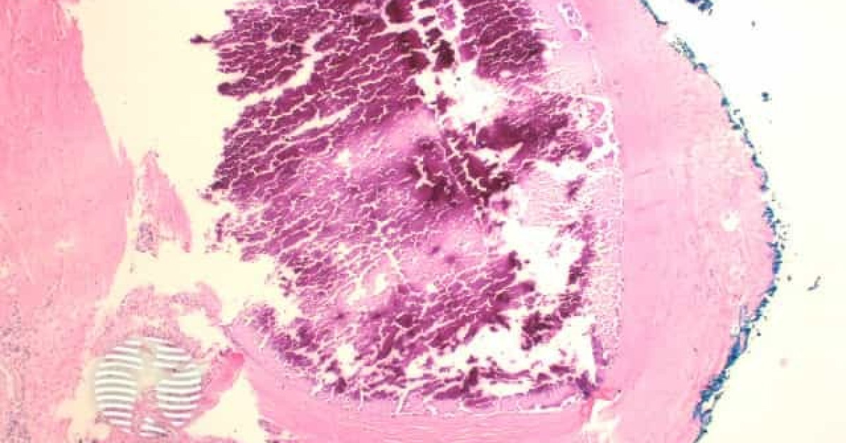 Calcinosis cutis histology image
