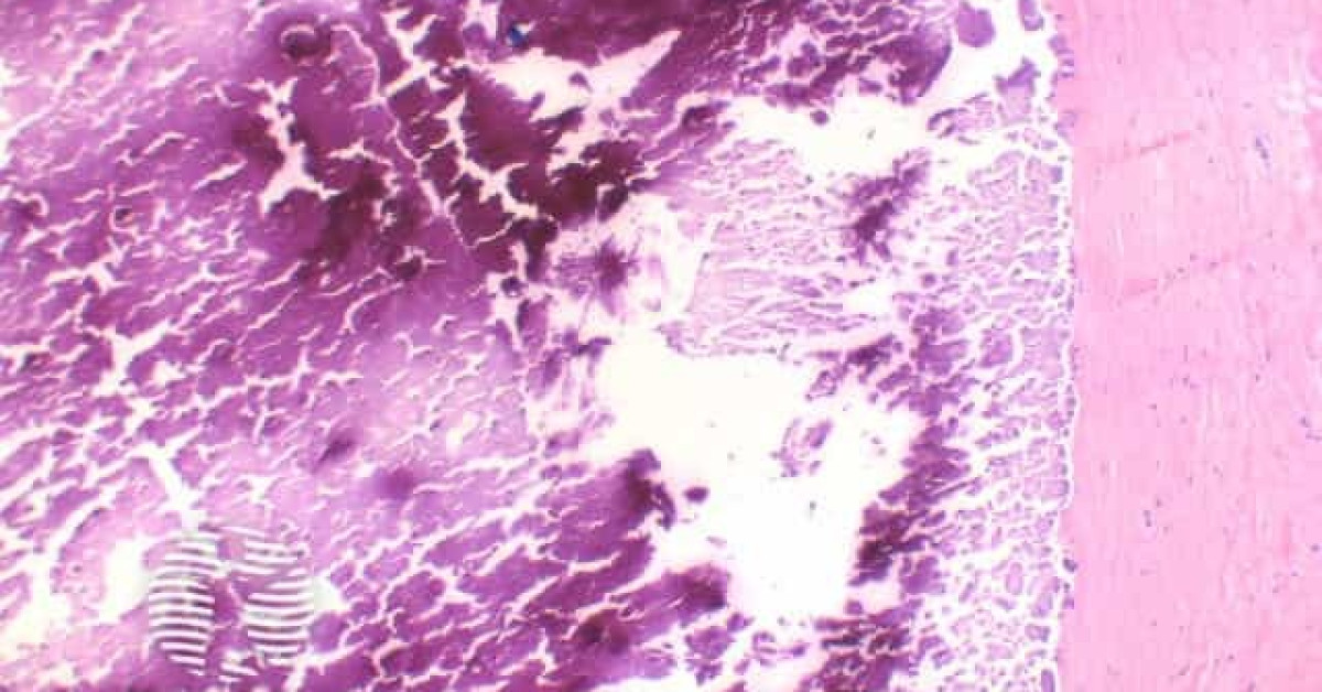 Calcinosis cutis histology image