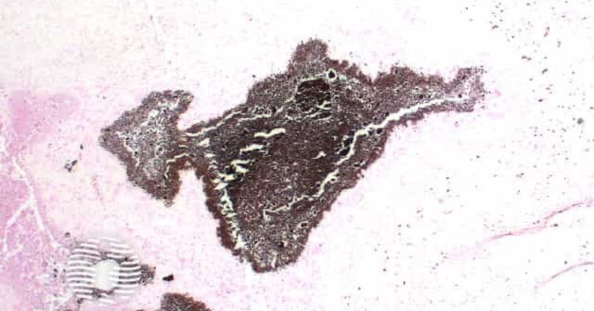 calcinosis cutis von Kossa silver stain image