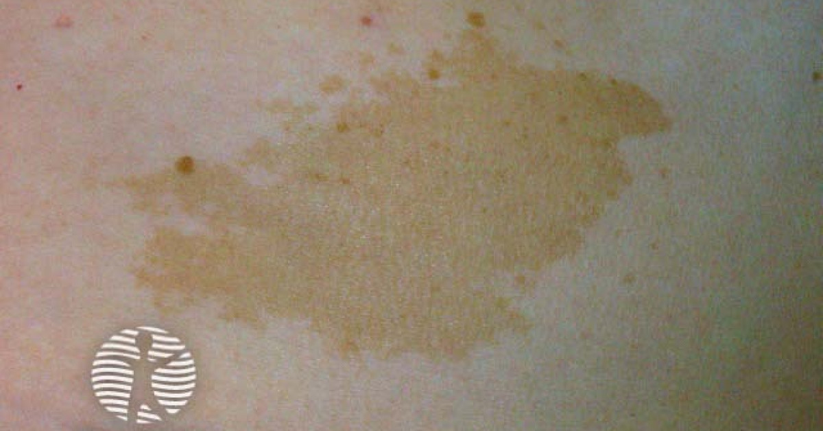 Images of cafe-au-lait macules image