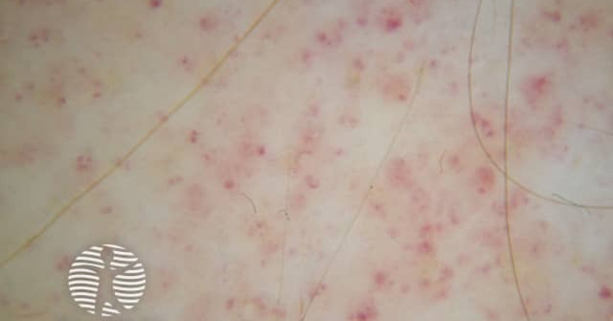 Dermoscopy of capillaritis image