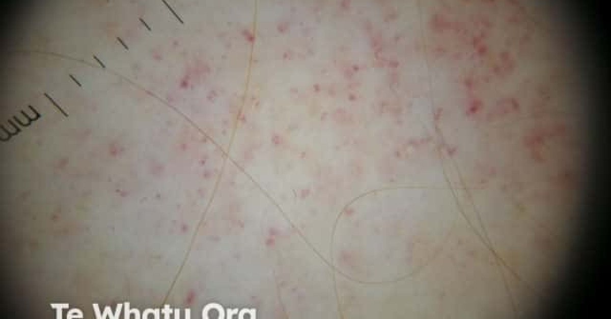 Dermoscopy of capillaritis image