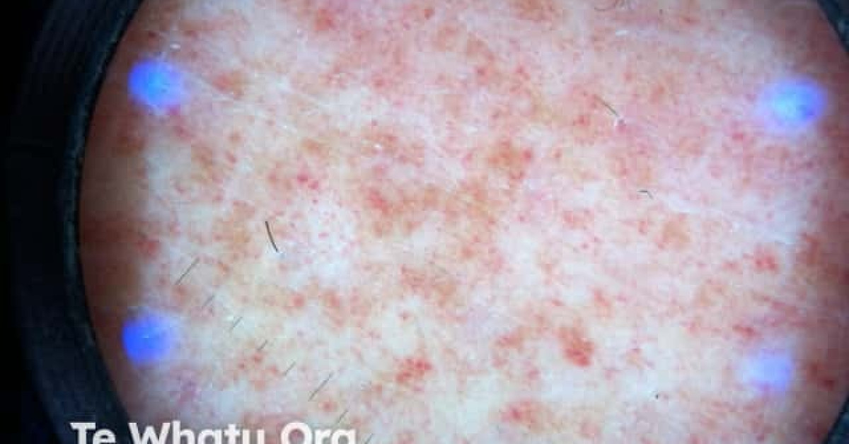 Dermoscopy of capillaritis image