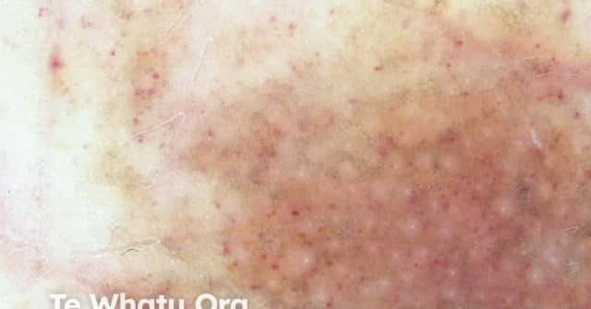 Dermoscopy of capillariti image