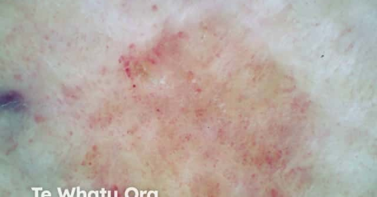 Dermoscopy of capillaritis image