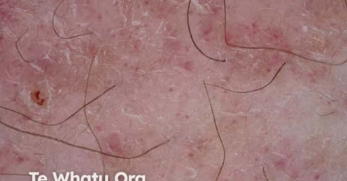 Dermoscopy of capillaritis image