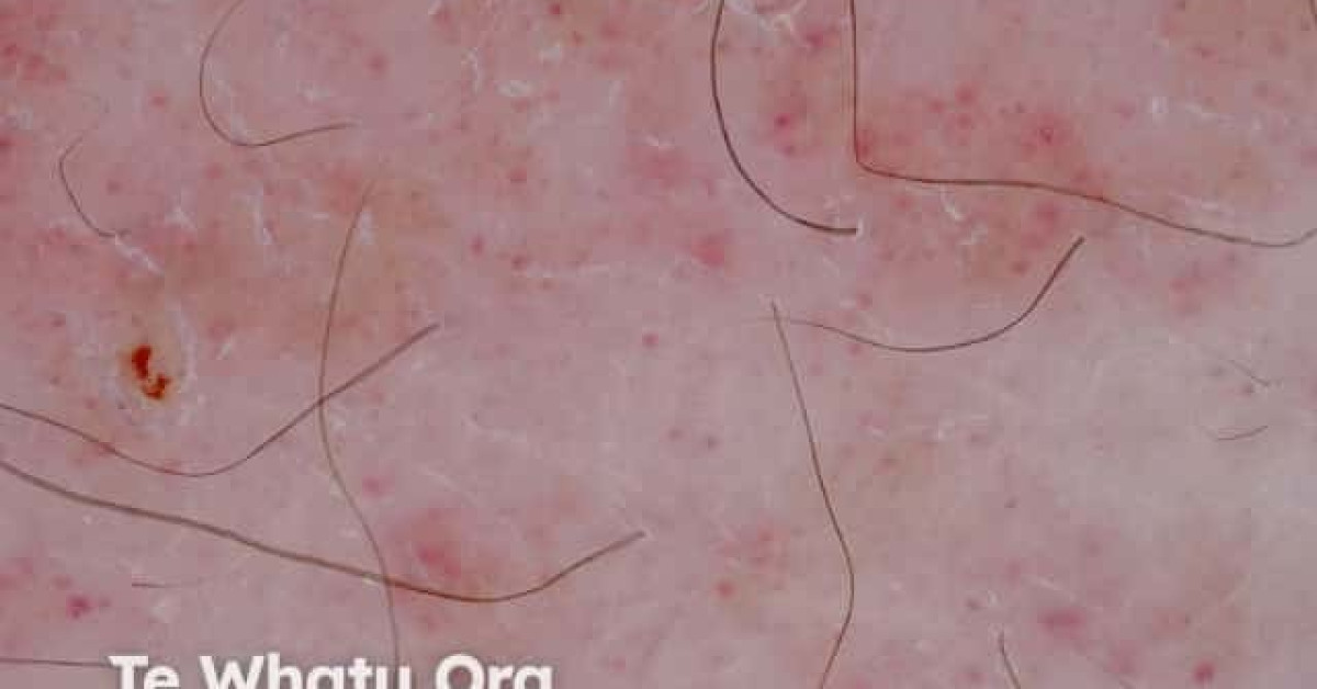 Dermoscopy of capillaritis image