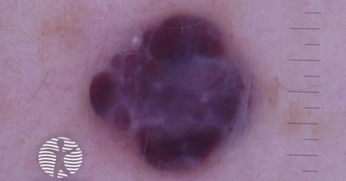 Cavernous haemangioma, nonpolarised dermoscopy view image