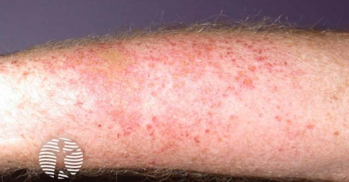 Acute irritant contact dermatitis image