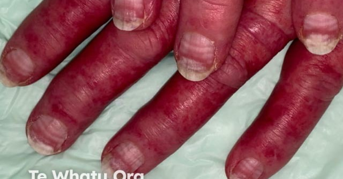 Nail changes due to chemotherapy image