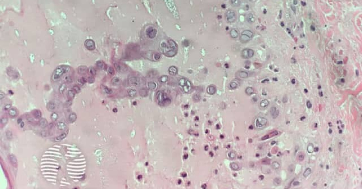 Chickenpox image