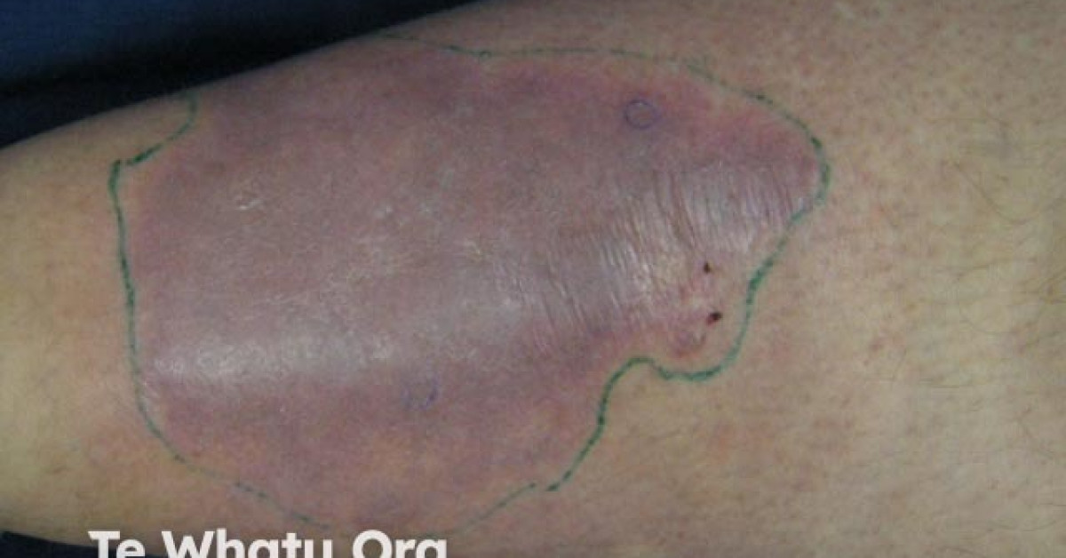 Chronic lipodermatosclerosis image