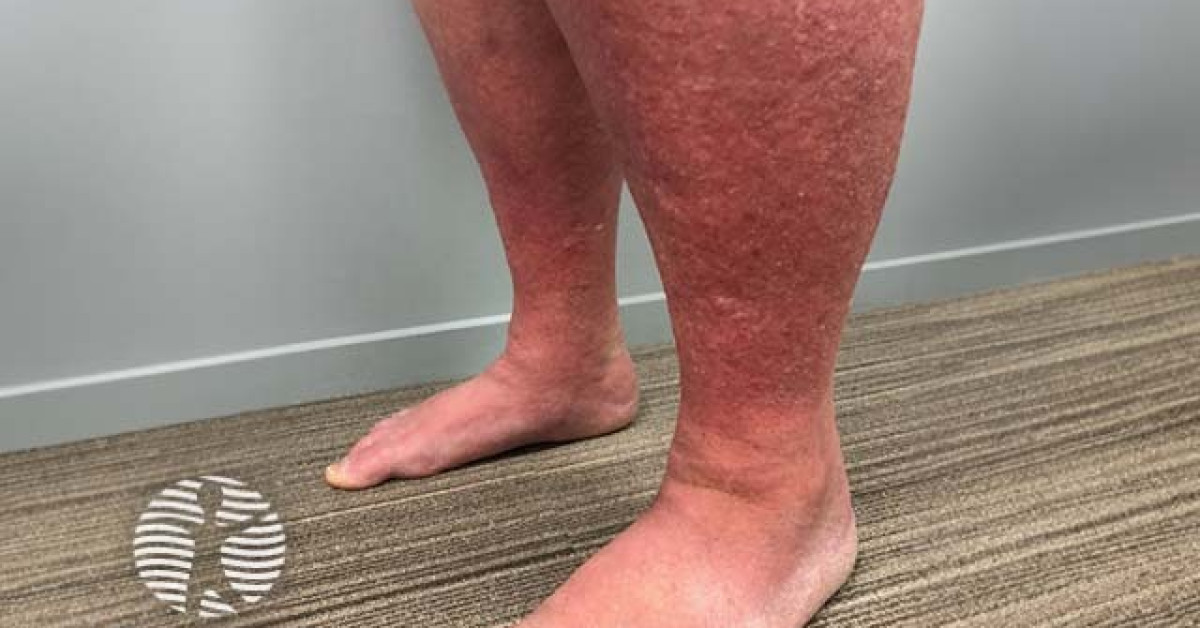 Chronic Lipodermatosclerosis Image