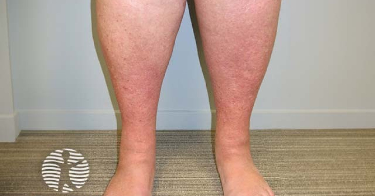 Chronic lipodermatosclerosis image