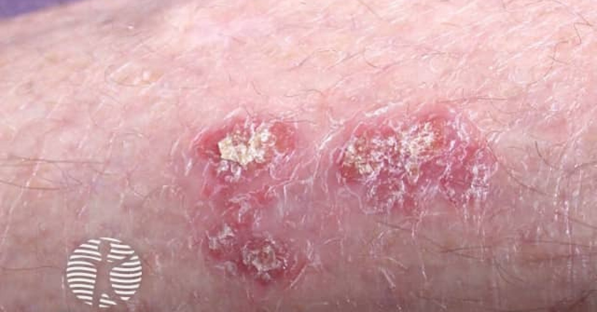 Chronic plaque psoriasis image