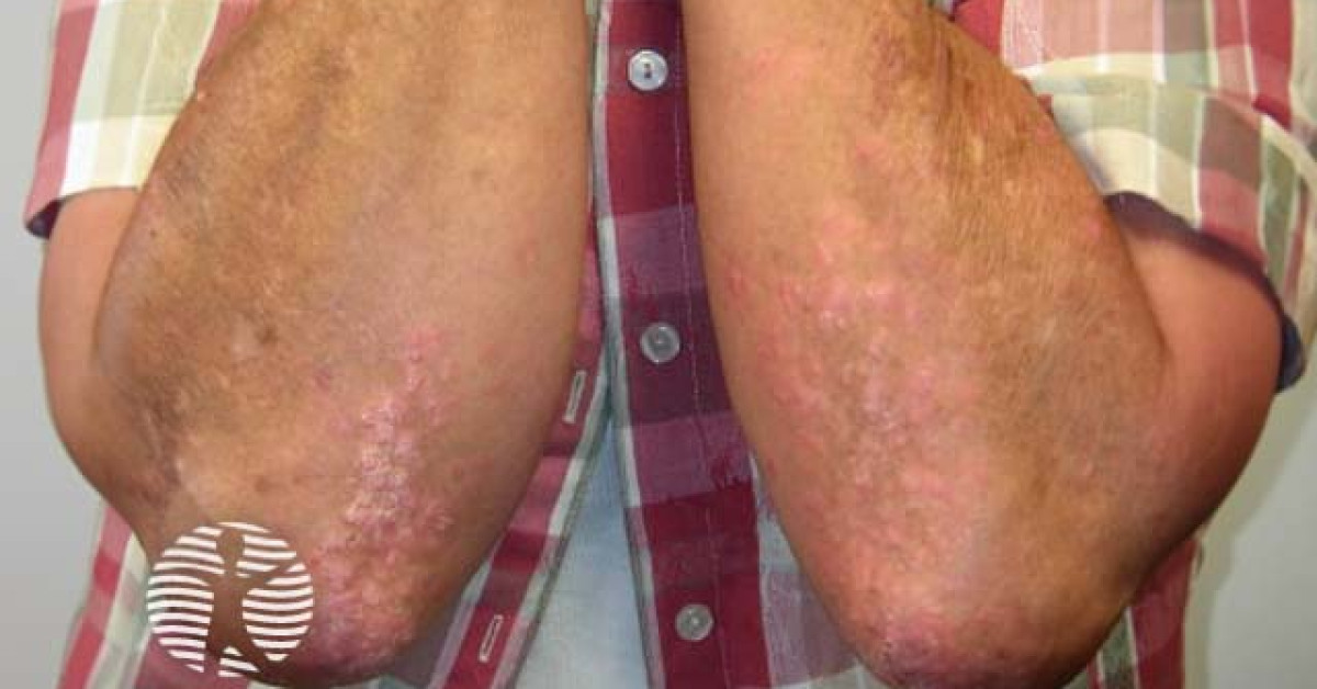 Chronic plaque psoriasis image