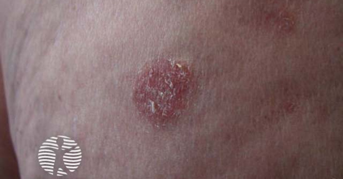 Chronic plaque psoriasis image