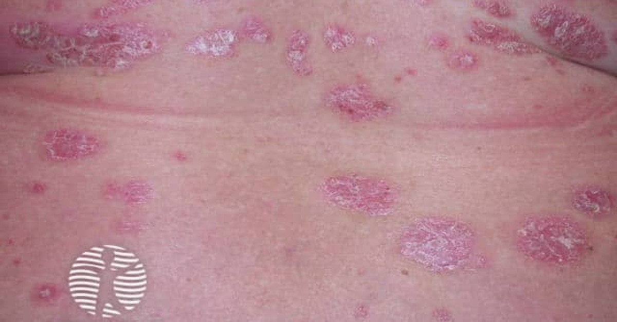 Chronic plaque psoriasis image