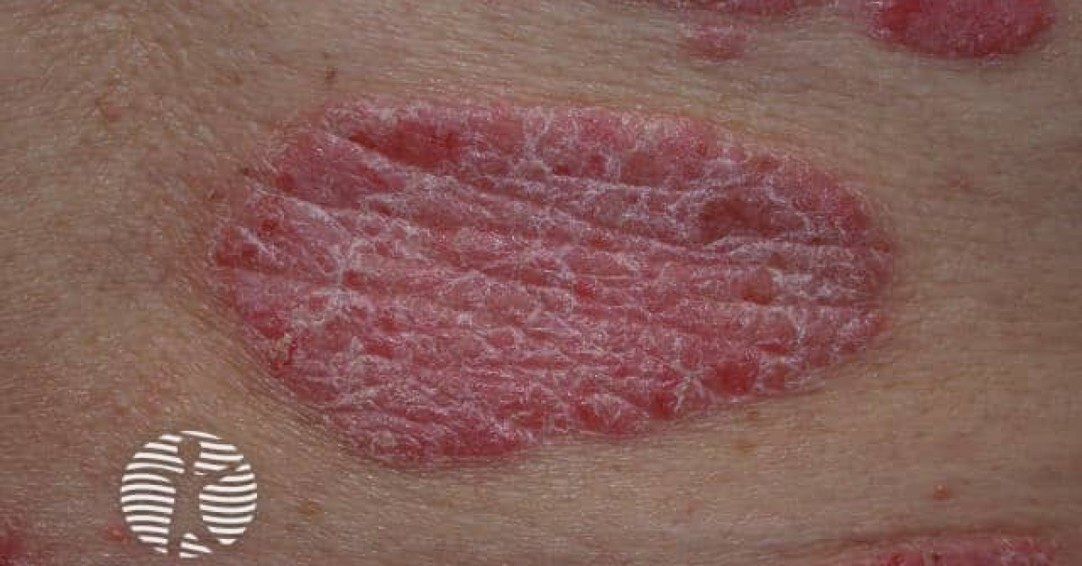 Chronic plaque psoriasis image