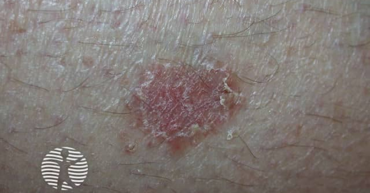 Chronic plaque psoriasis image