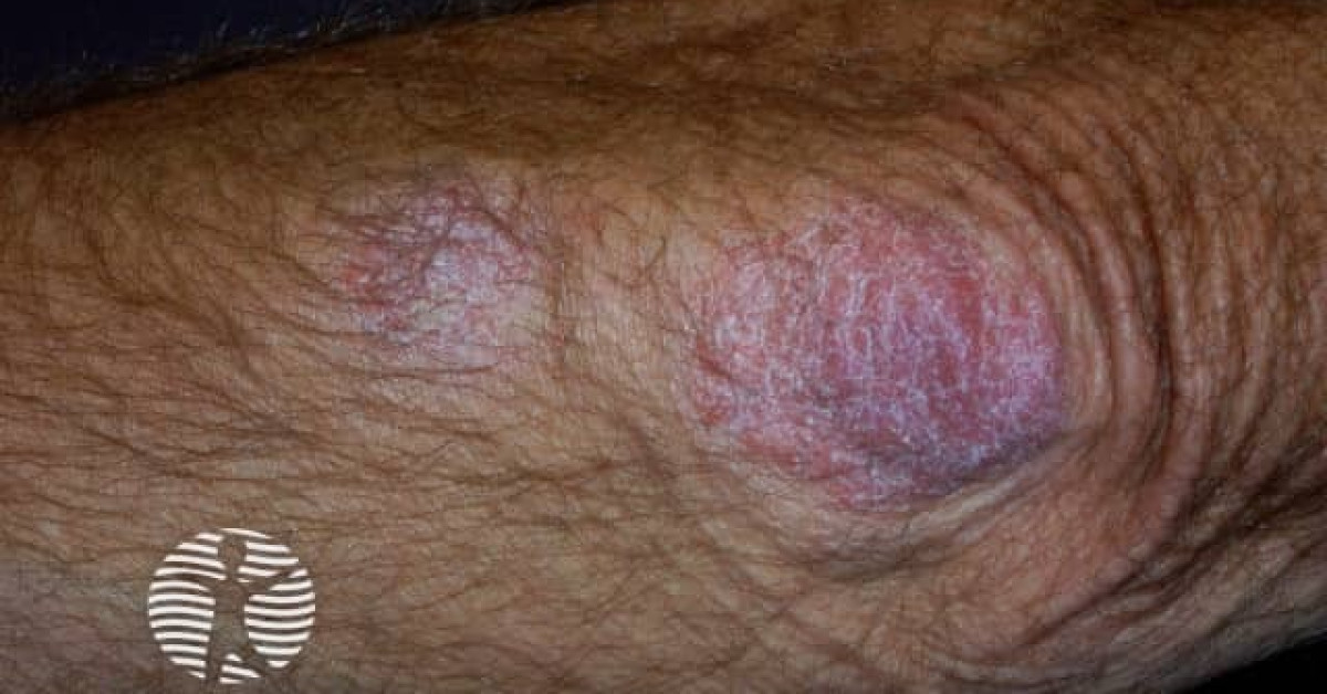 Chronic plaque psoriasis image