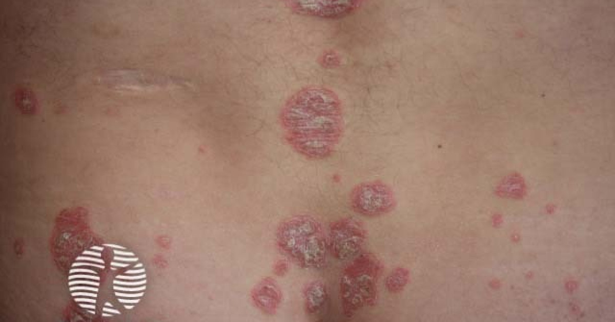 Chronic plaque psoriasis 19 image