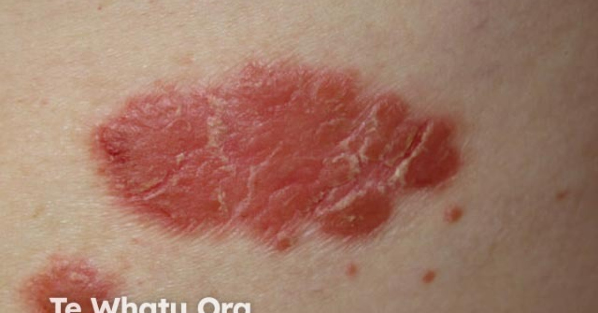 Chronic plaque psoriasis image