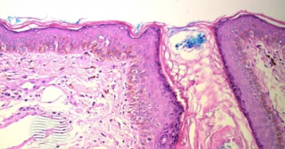 Histology of melanoma in situ image