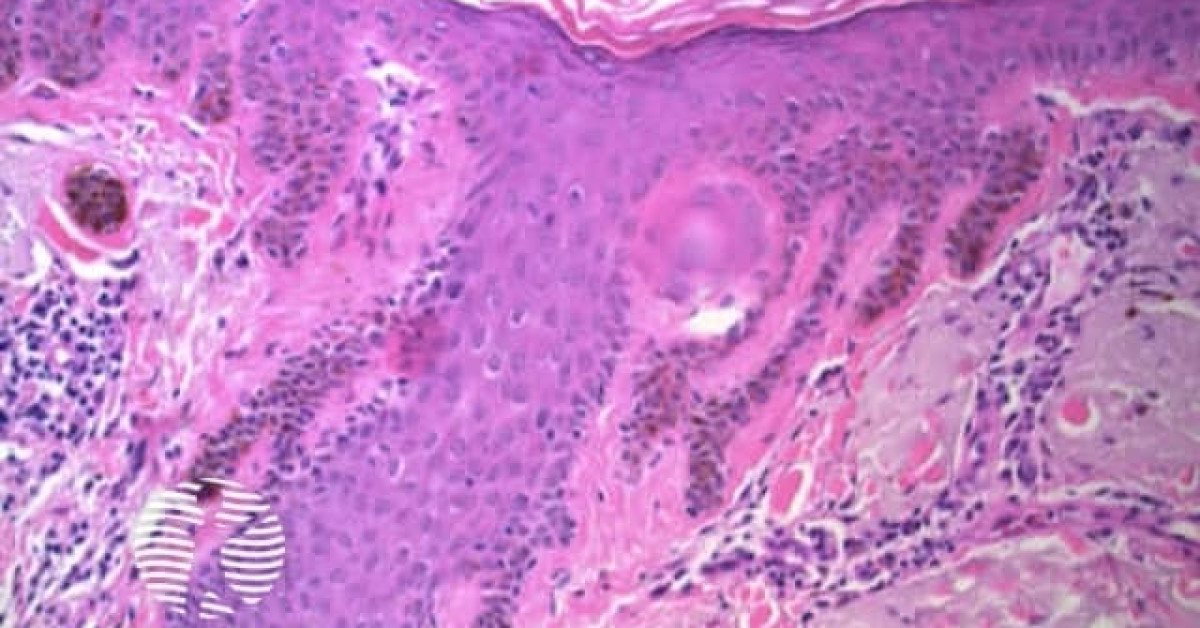 Histology of a solar lentigo image