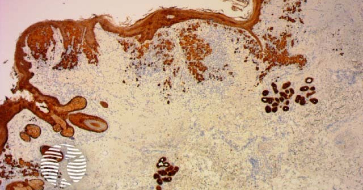 Lichen planus showing Civatte bodies on histology stained with ...