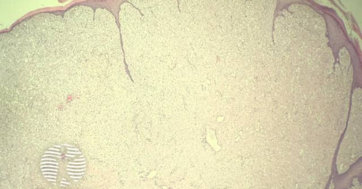 Clear cell fibrous papule pathology image