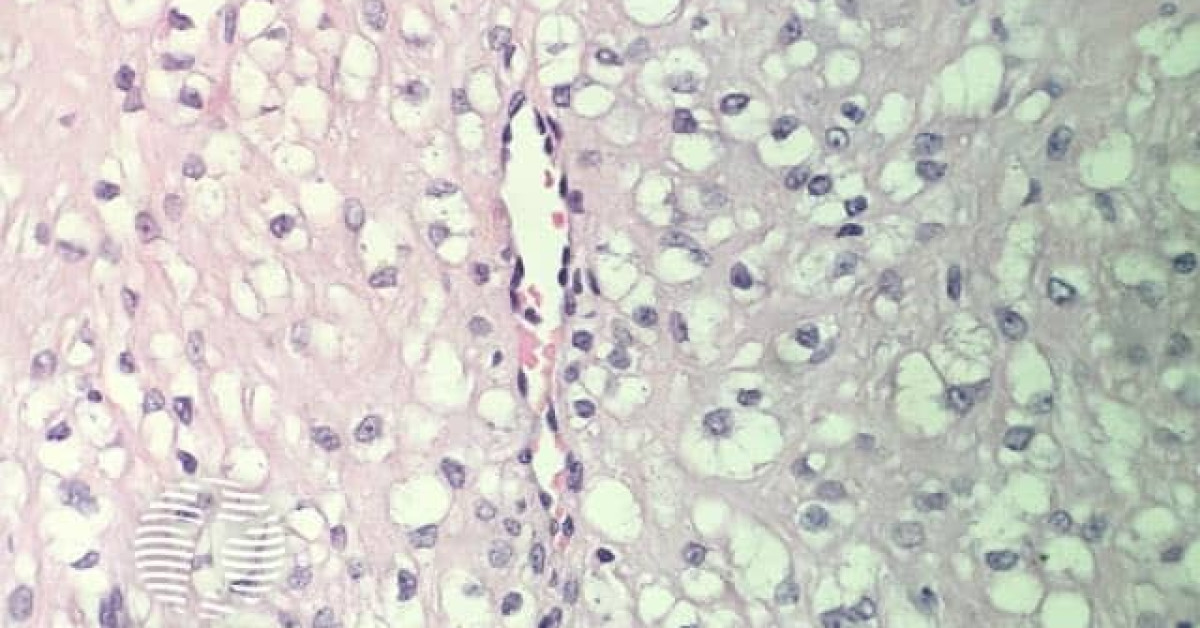 Clear cell fibrous papule pathology image