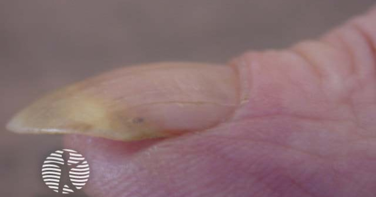 Nail clubbing associated with lung cancer image