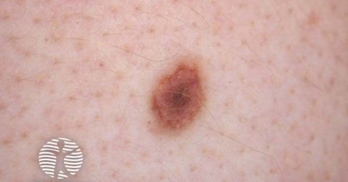 Cockade naevus image