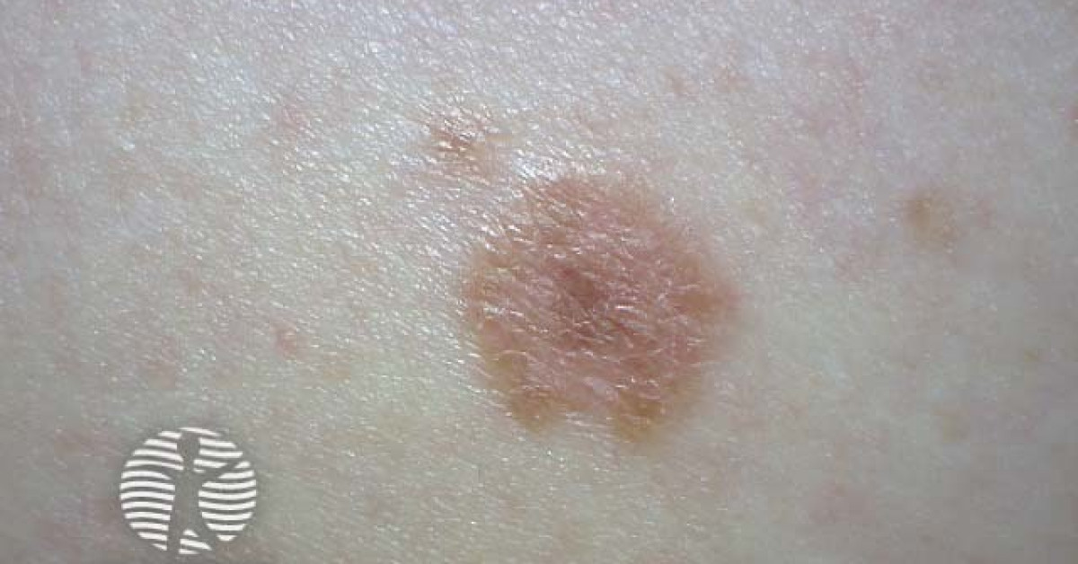 Cockade naevus image