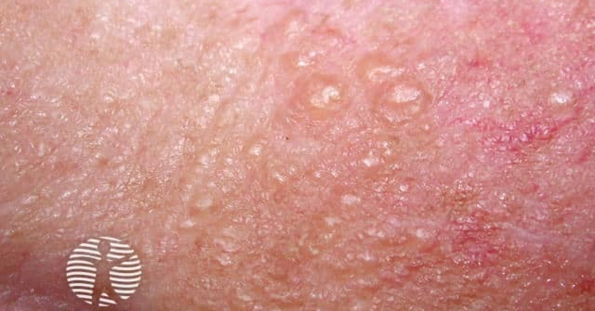 Adult colloid miliu image