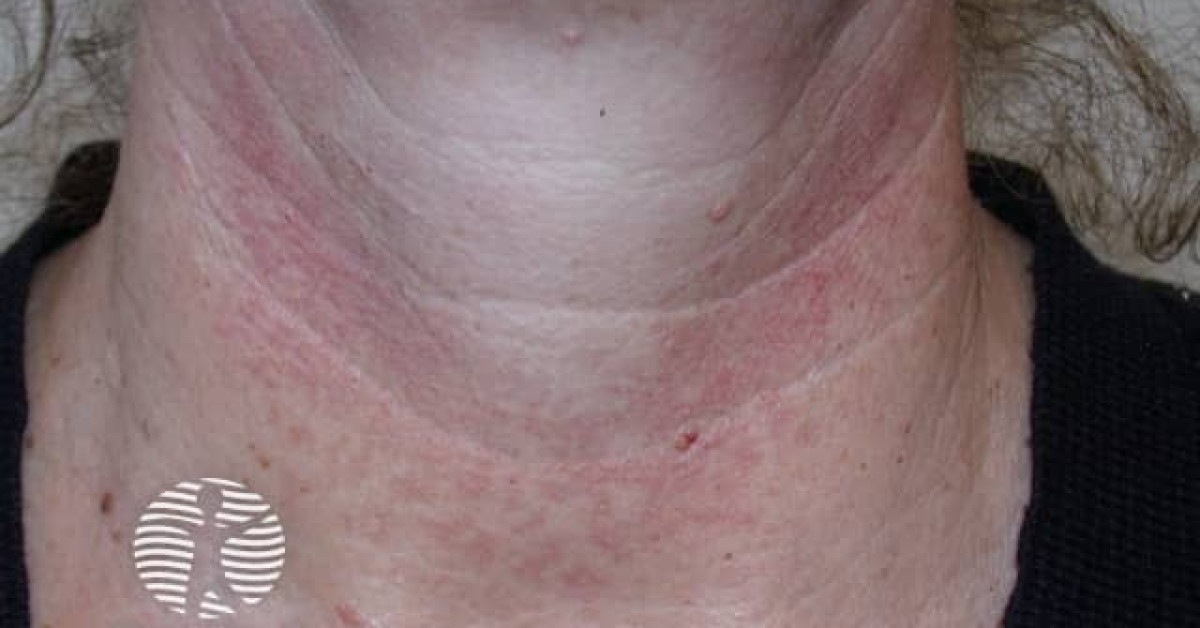 Poikiloderma Of Civatte Image