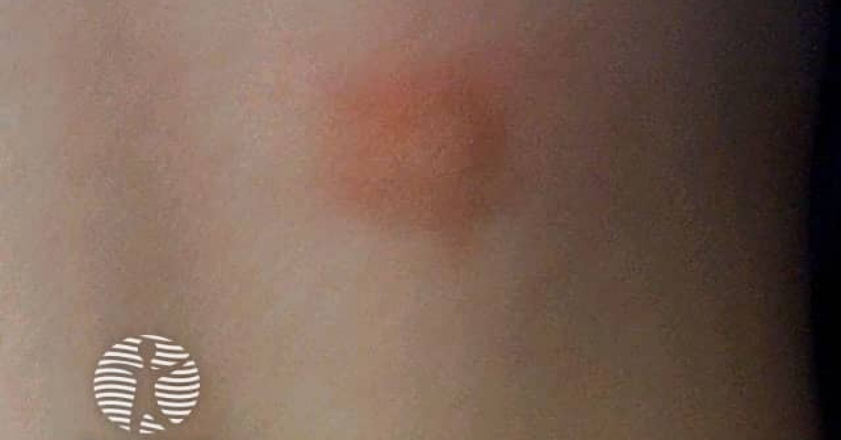 Urticaria pigmentosa image