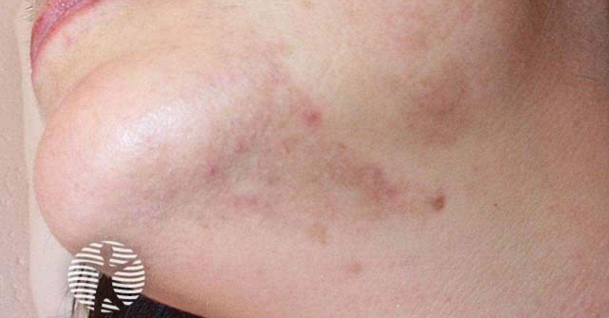 Postinflammatory hyperpigmentation due to acne image