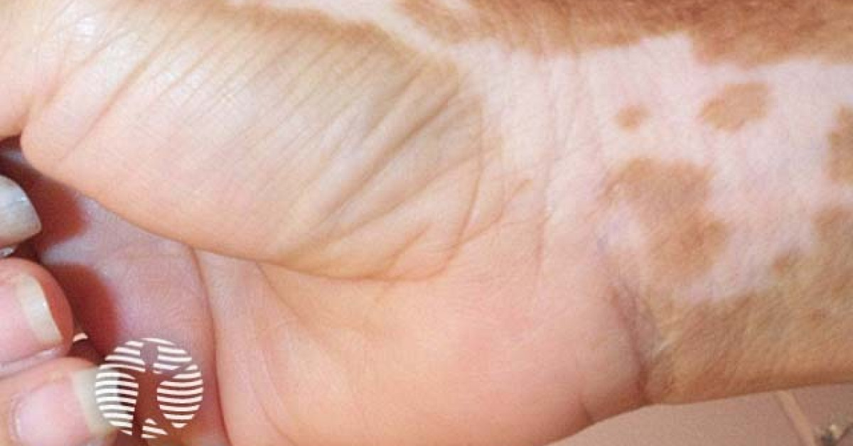 Postinflammatory hypopigmentation: Thermal burn image