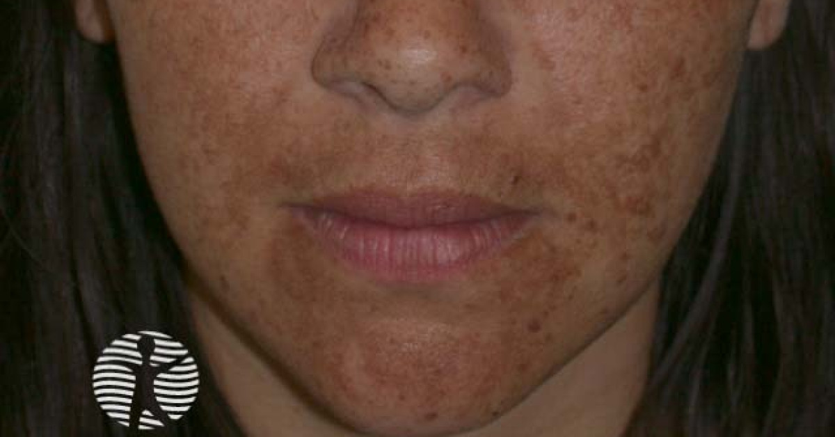 Melasma image