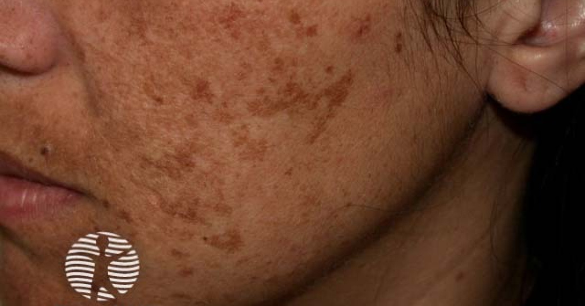 Melasma image