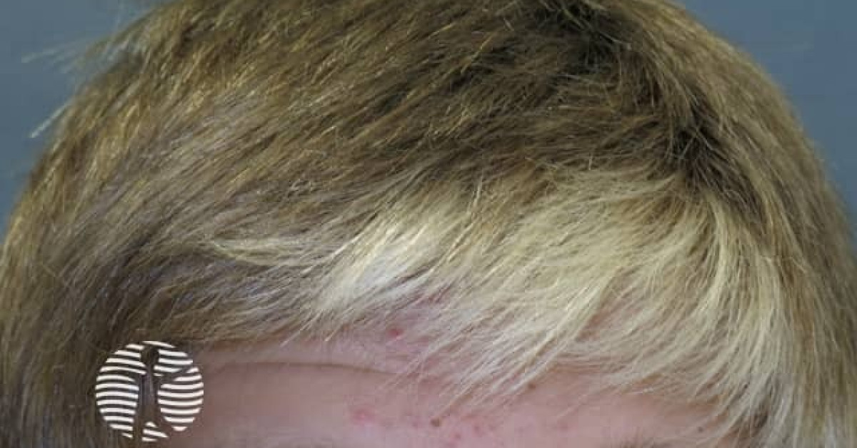 Piebaldism: white forelock image