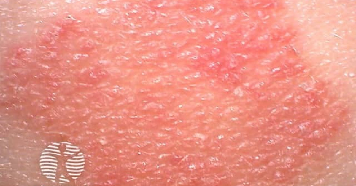 Red patch of psoriasis image