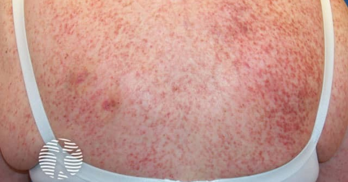 Telangiectatic cutaneous mastocytosis image